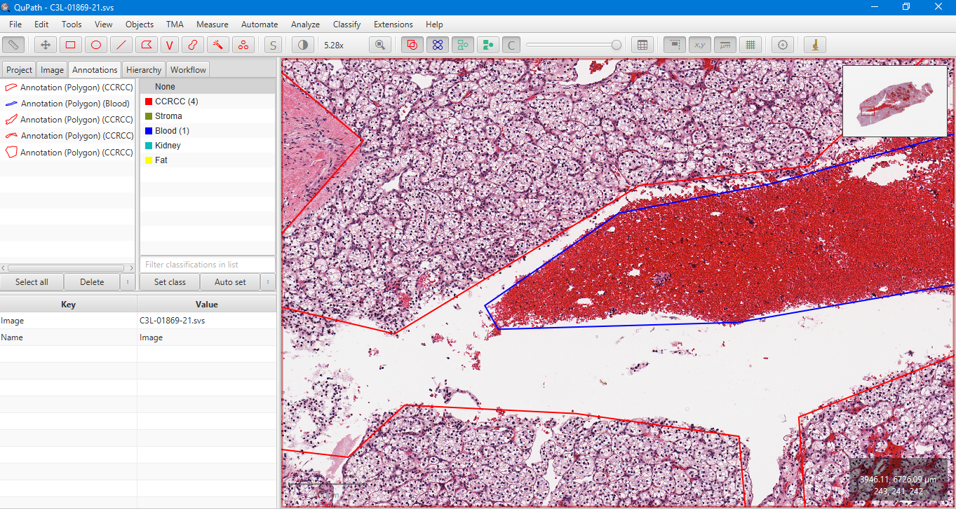 GitHub - bluewhale28/Classification-of-images-with-clear-cell-renal ...