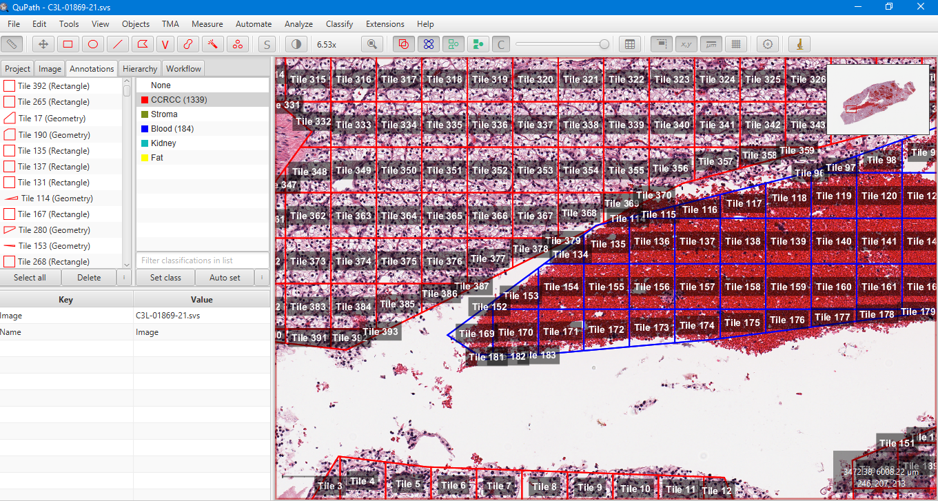 GitHub - bluewhale28/Classification-of-images-with-clear-cell-renal ...