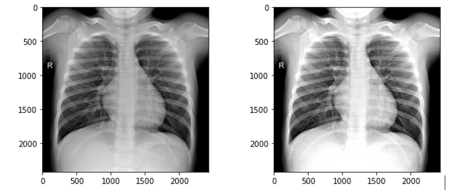 GitHub - vishal-khot/pneumonia-detector