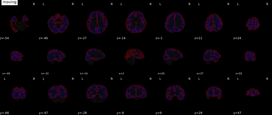 Something wrong with susceptibility distortion correction and alignment for resting-state data ...