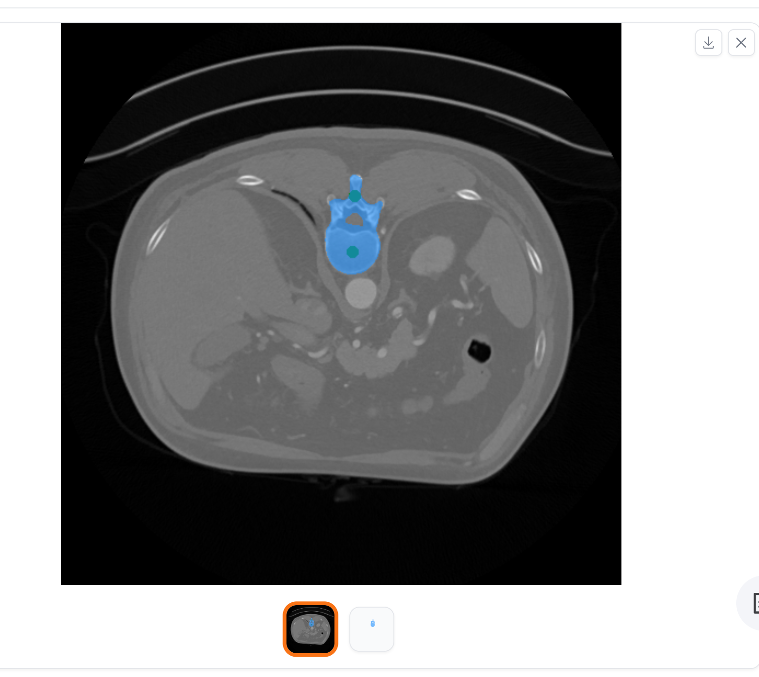 Bad case · Issue #1 · OpenGVLab/SAM-Med2D · GitHub