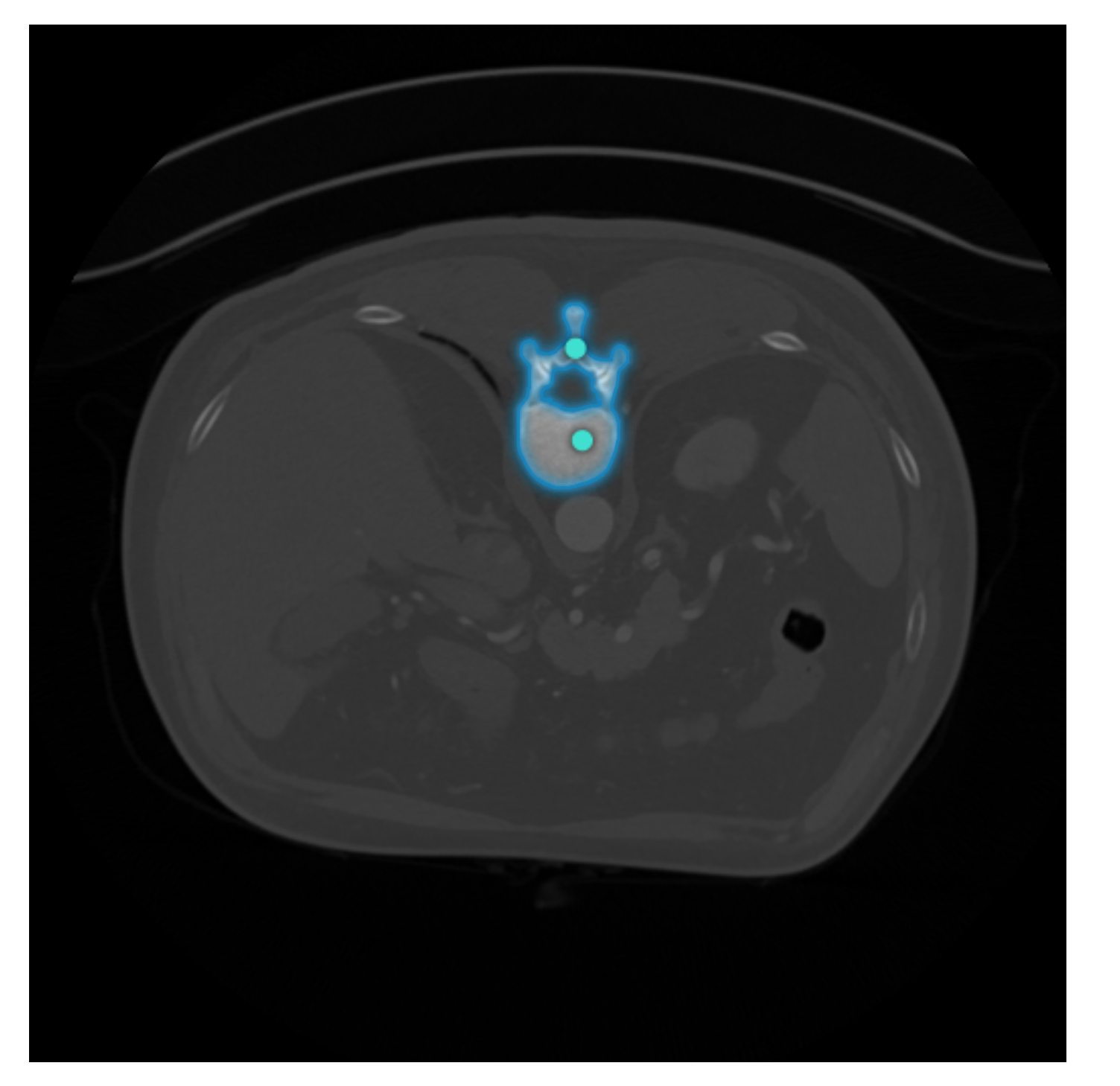 Bad case · Issue #1 · OpenGVLab/SAM-Med2D · GitHub