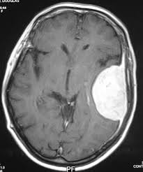 GitHub - Vishal335/Brain-Tumor-Detection-Using-Matlab