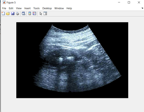 GitHub - adarshpandey-03/KidneyStoneDetection_UsingUltrasoundImage
