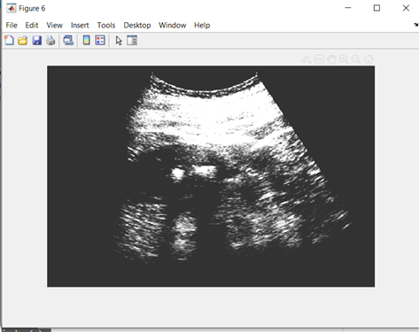 GitHub - adarshpandey-03/KidneyStoneDetection_UsingUltrasoundImage