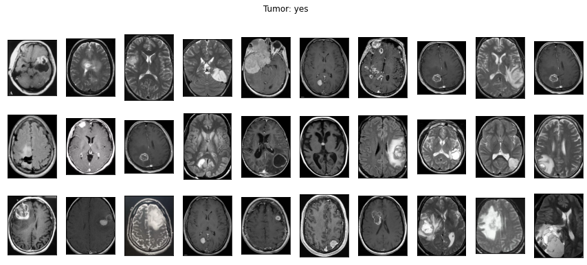 GitHub - Shreyas-Bhat/Brain_Tumor_Classifier: Used CNN based models like ResNet101 and ...
