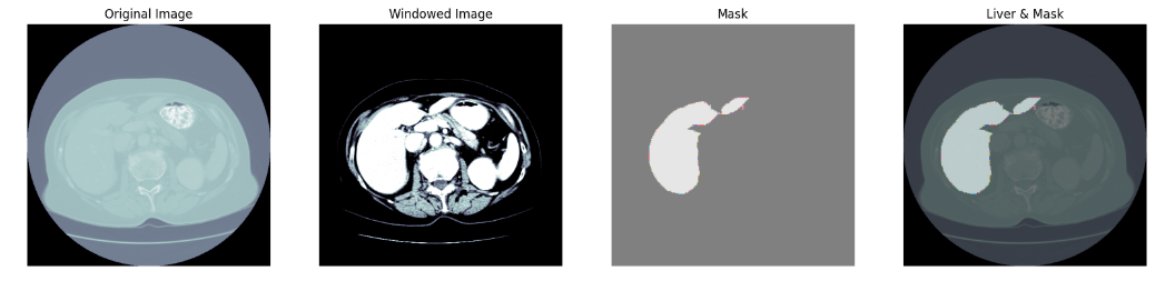 Github Deepdewdeep Liver Tumor Segmentation
