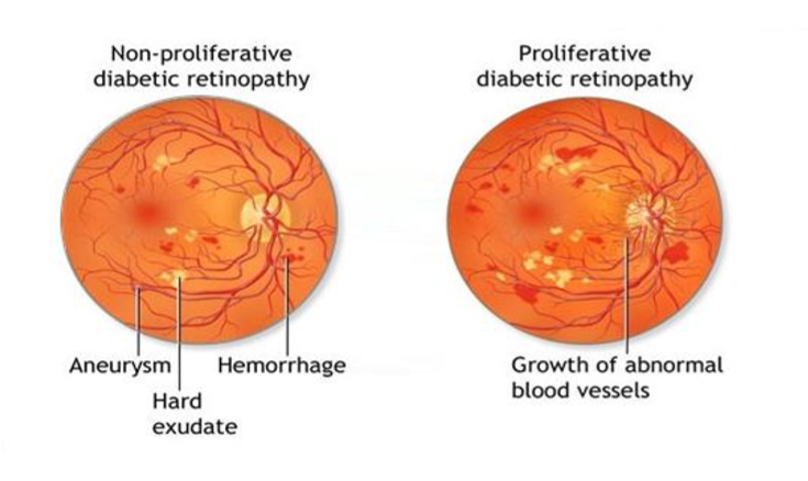 GitHub - Ibtihel-ouni/Diabetic-Retinopathy-Detection-System-Based-on-Neural-Networks