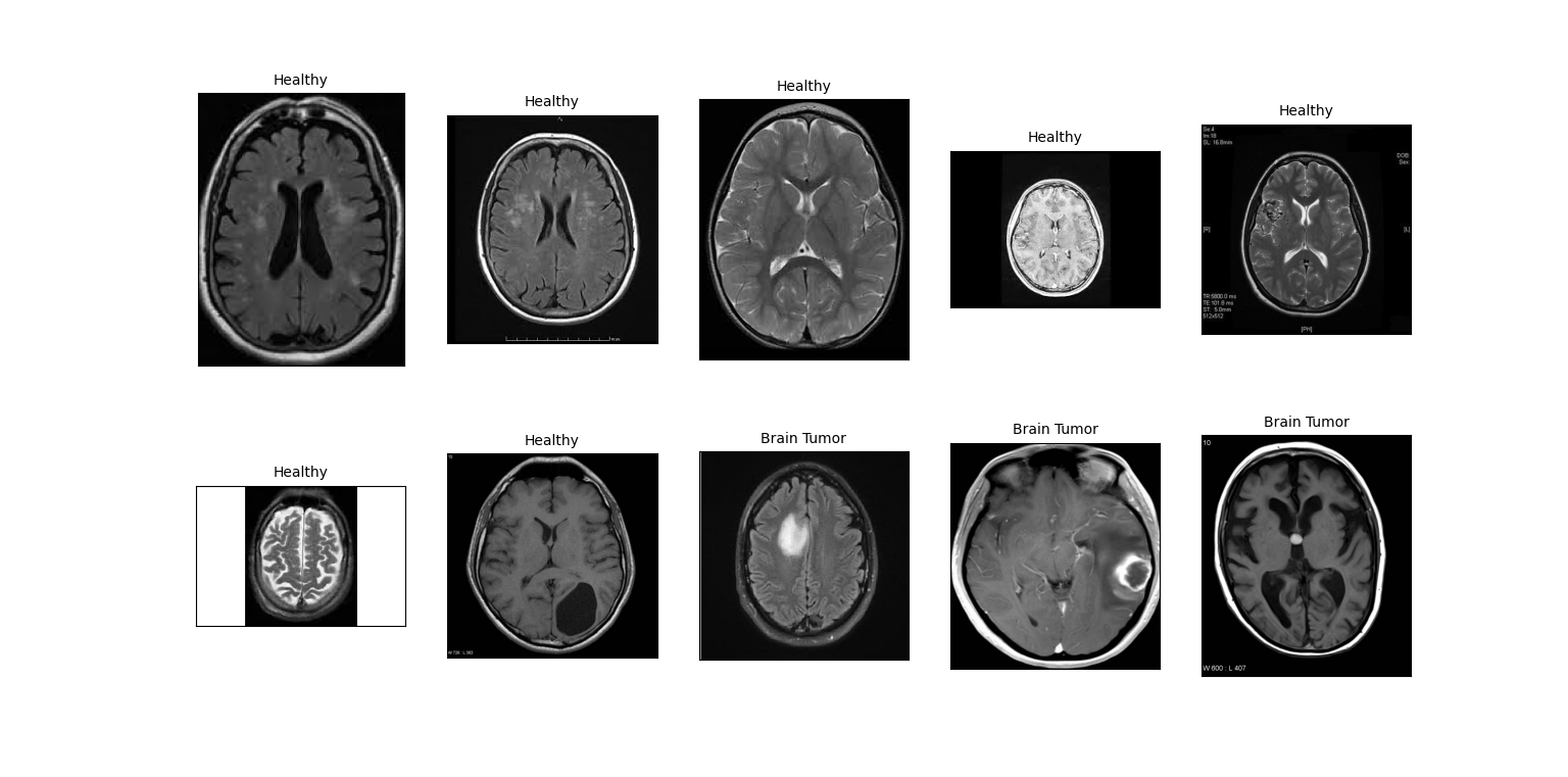 GitHub - Ray9090/Brain-Tumor-Detecton-_-Deep-Learning: Brain MRI Images ...