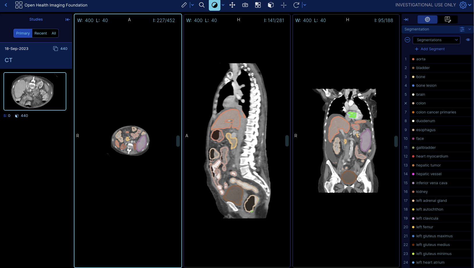 Ohif V3 Monai Plugin Segmentation Panel Add Toolbox And Scroll Bar · Issue 1555 · Project