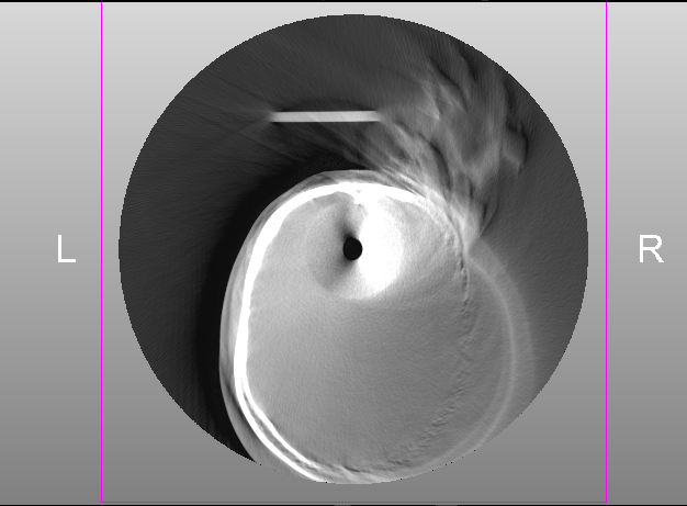 Hole in FDK reconstruction with data overlap · Issue #392 · RTKConsortium/RTK · GitHub