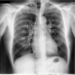 GitHub - Shimonimehrotra/Automatic-Lung-Segmentation: In this project ...