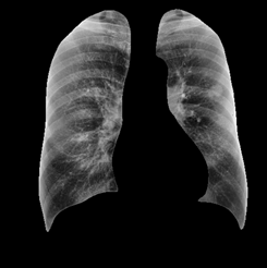 GitHub - Shimonimehrotra/Automatic-Lung-Segmentation: In this project ...