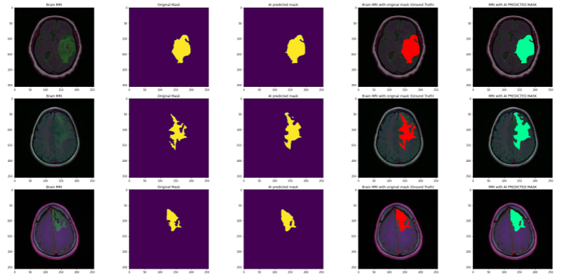 GitHub - SahinTiryaki/Brain_tumor_segmentation_Vgg19UNet: Brain tumor segmentation was performed ...