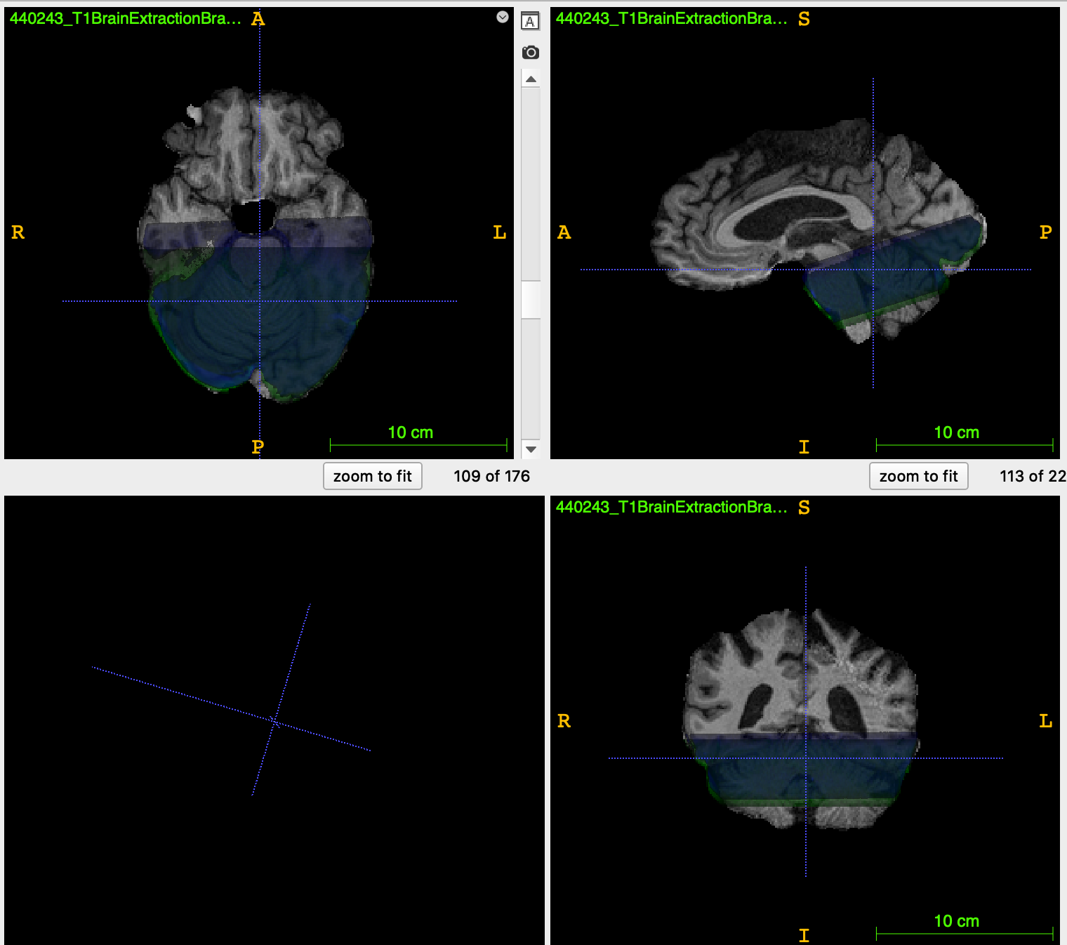 poor coregistration of T1 and partial FOV image with antsRegistration ...