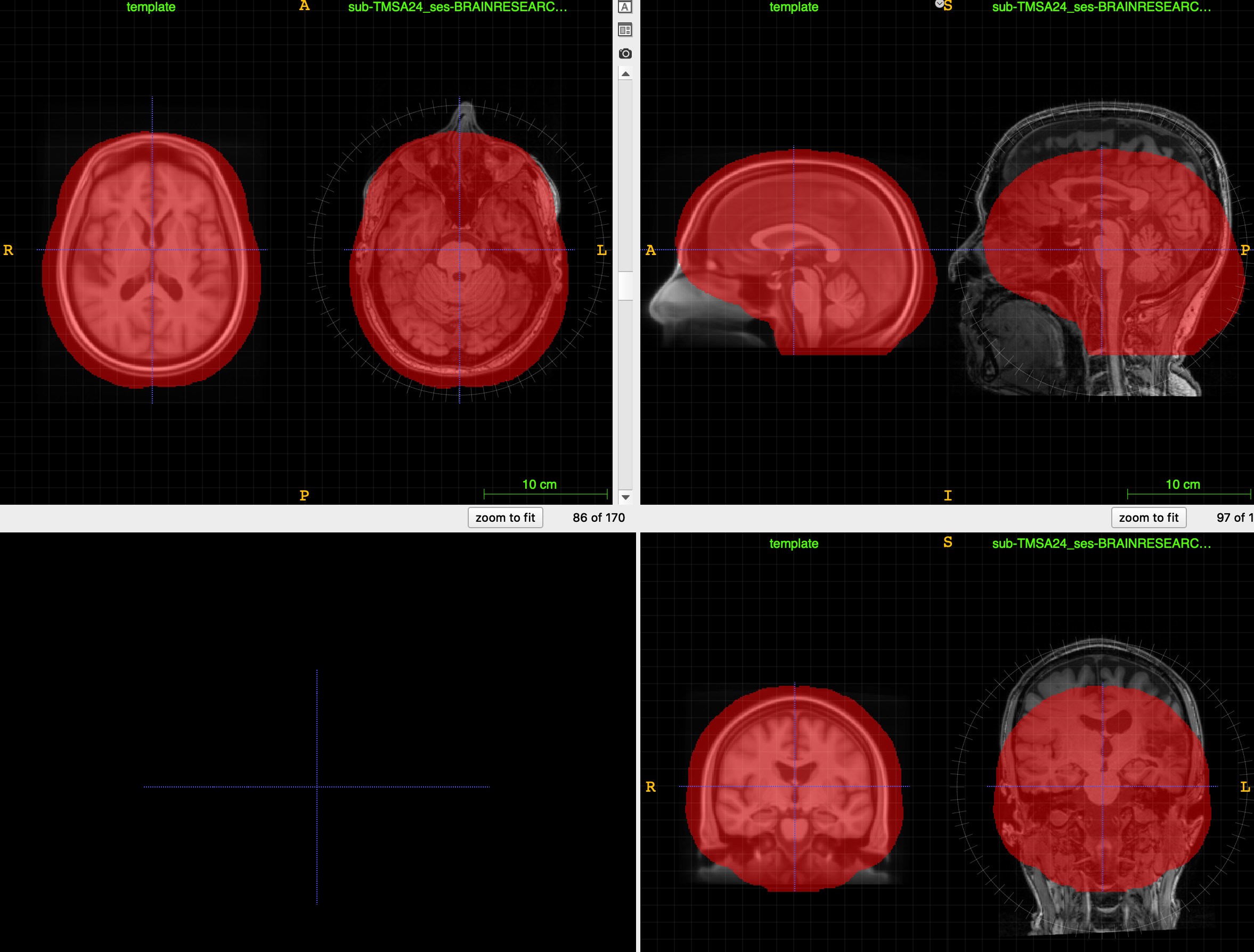 ANTs Brain extraction doesn't work for a few subjects in a project ...