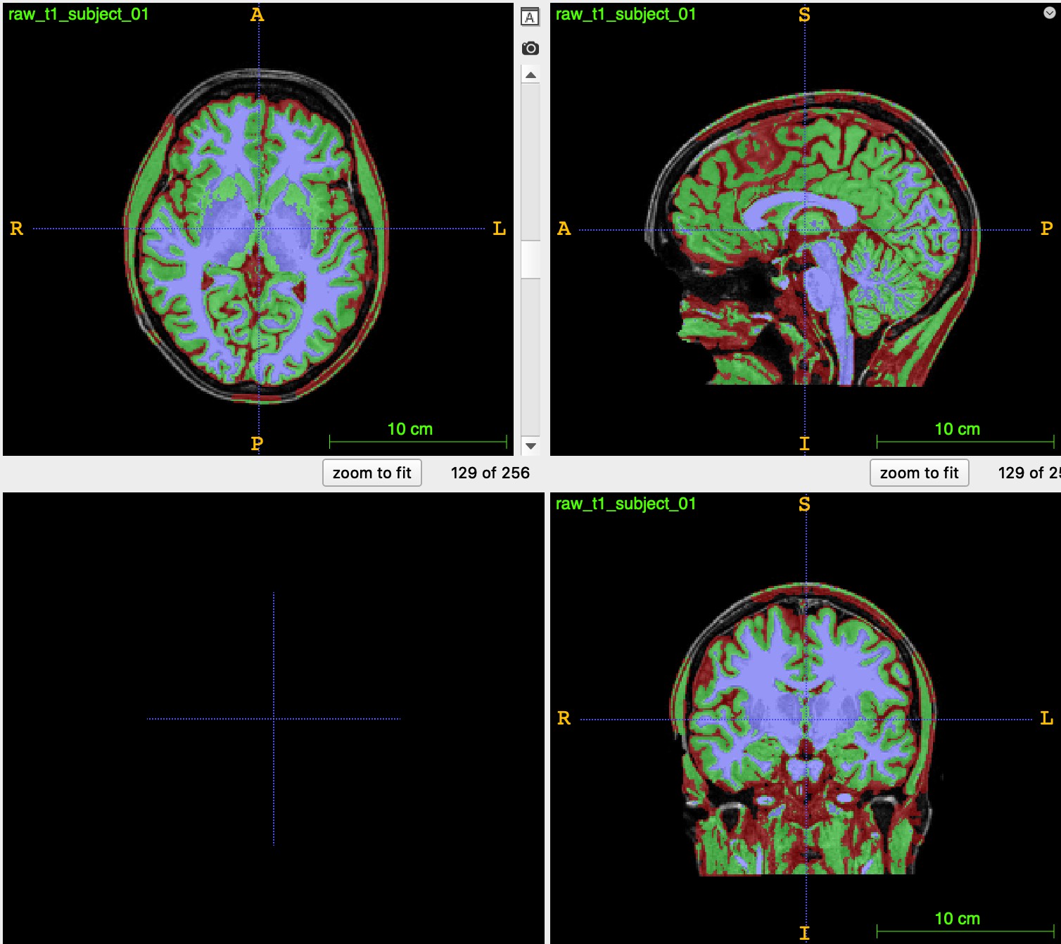 Kelly Kapowski algorithm for computing cortical thickness takes too long to execute · Issue #388 ...