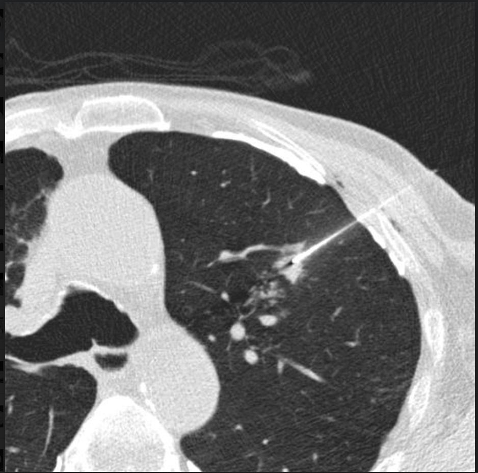 GitHub - heyyitsemyy/CT-Needle-Image-Classification