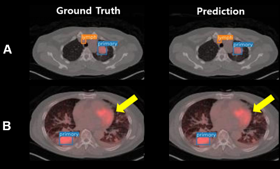 GitHub - hse801/LungCancerDetect: Lung Cancer and Lymph Node Metastasis ...