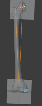 GitHub - VIVEKNITW/Femur-Pre-op-Planning-in-Blender-using-Python ...