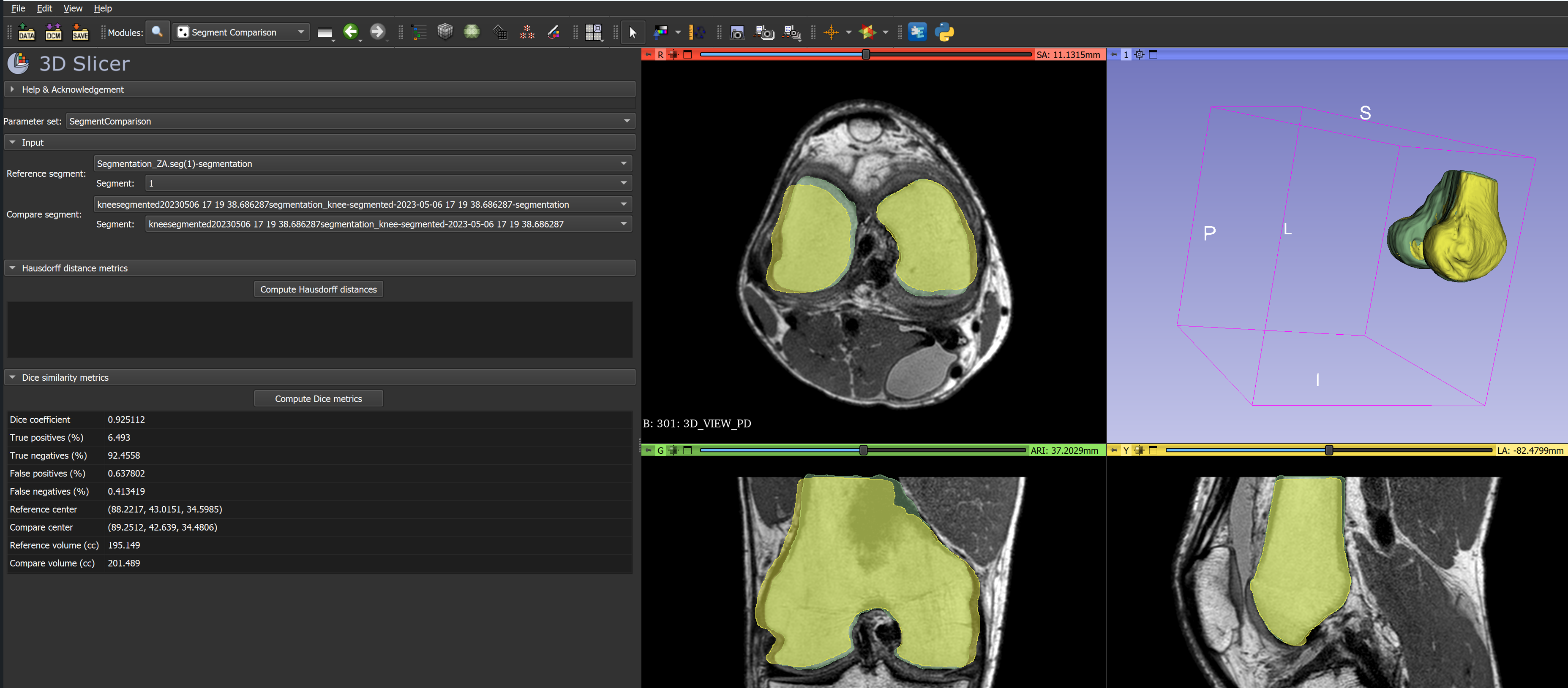 GitHub - matan034/Knee-Bone-Segmentation