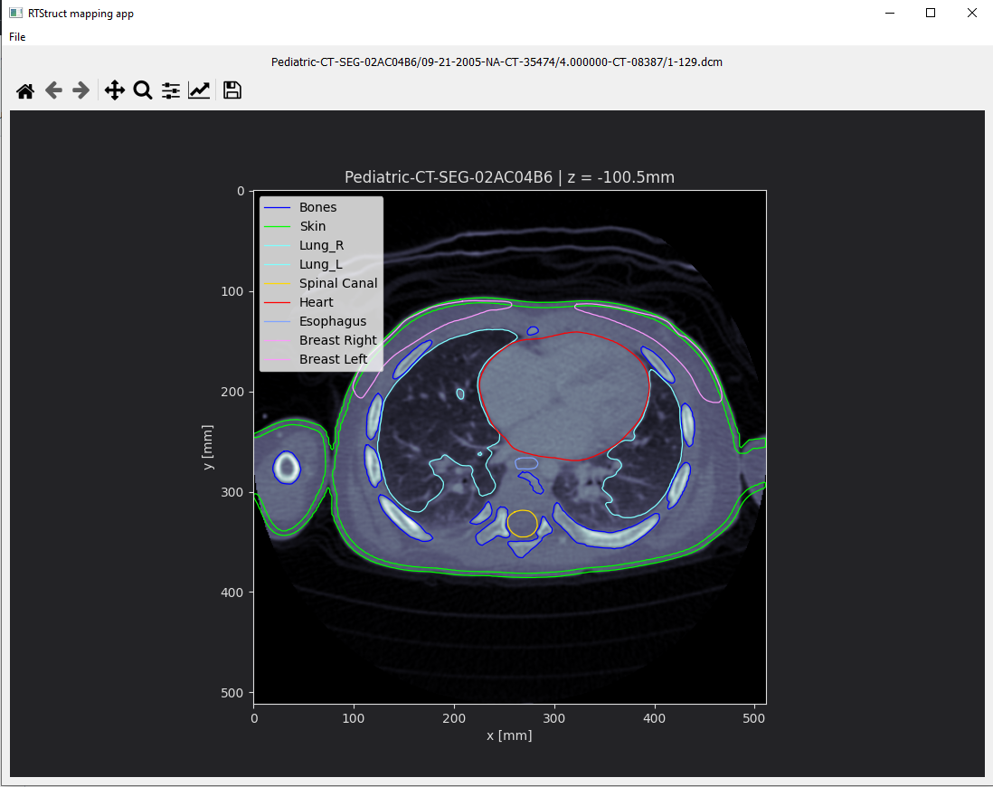 GitHub - rzelazo/RTStruct-on-CT-image: Oprogramowanie do wizualizacji struktur RTStruct ...