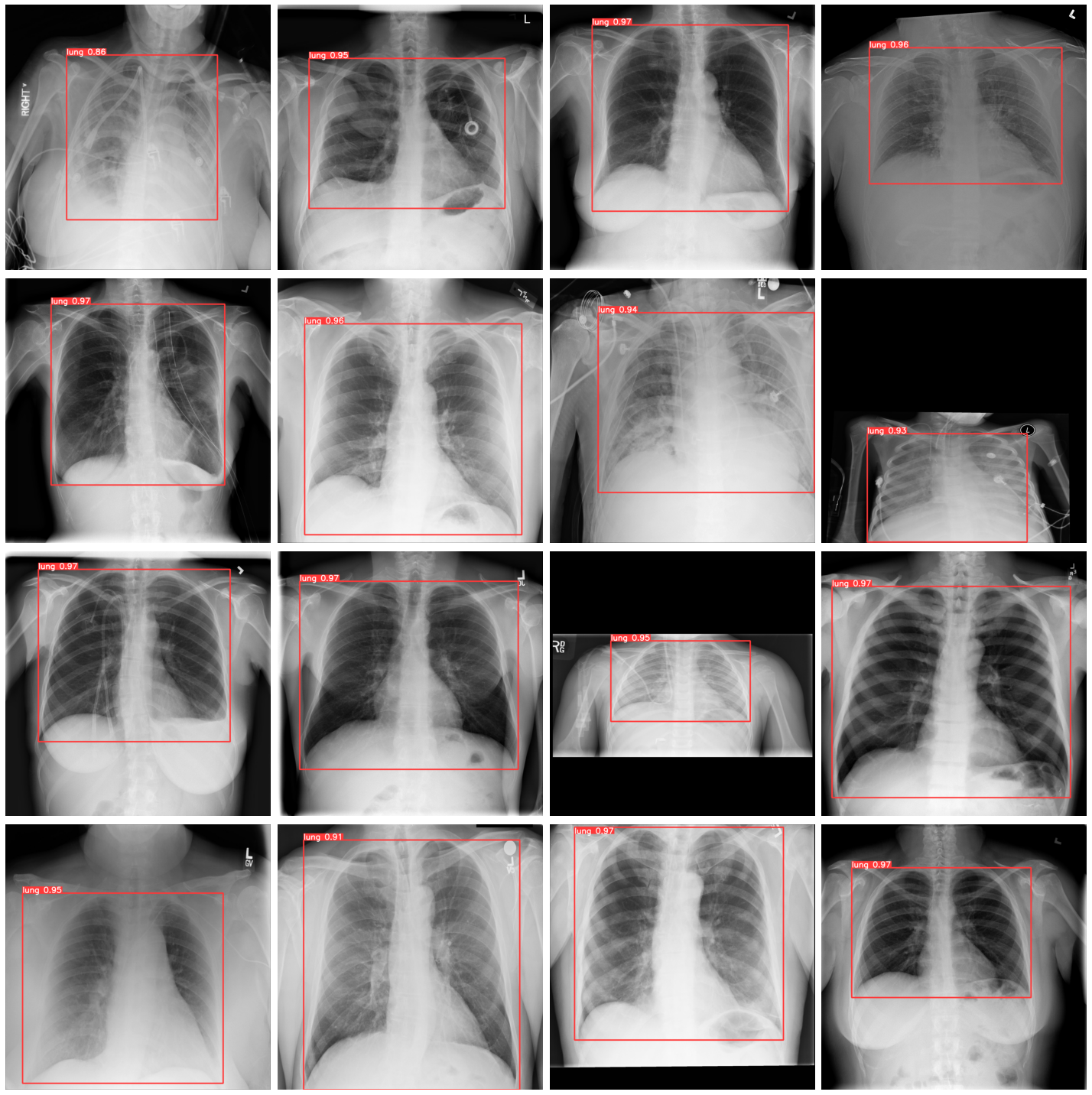 GitHub - KANGHANNARA/RSNA_Pneumonia_Detection