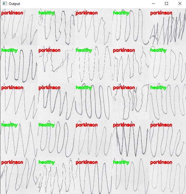 GitHub - Midhunsriram/Parkinson-Disease-Predictor: Predicting Parkinson ...