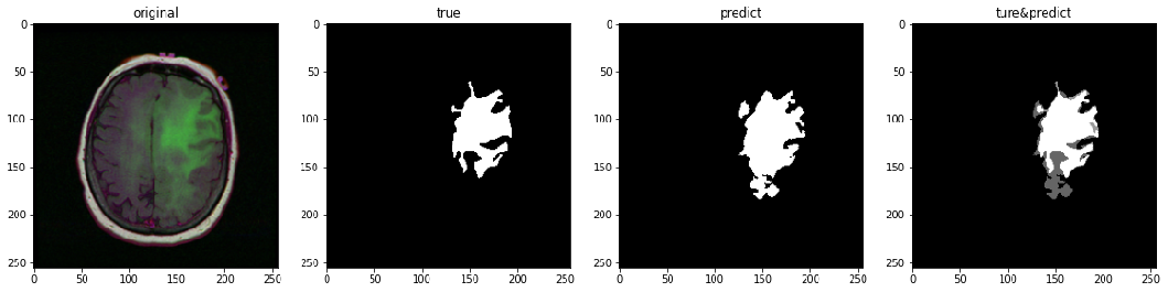 GitHub - KurisuZhang/CNN-for-Brain-Lesion-Segmentation-in-MRI-Images ...