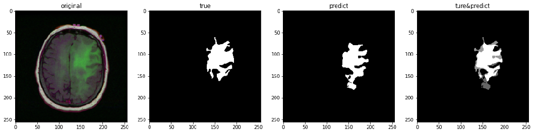 Github Kurisuzhang Cnn For Brain Lesion Segmentation In Mri Images In This Work Four Popular