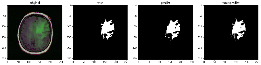 GitHub - KurisuZhang/CNN-for-Brain-Lesion-Segmentation-in-MRI-Images ...