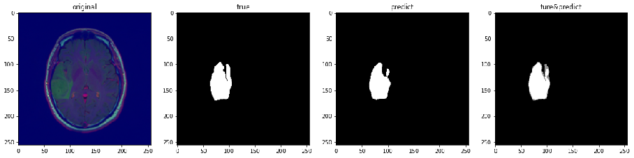 Github Kurisuzhang Cnn For Brain Lesion Segmentation In Mri Images In This Work Four Popular