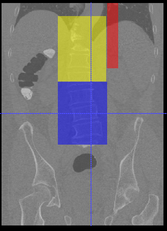 [Question] big object across patches · Issue #147 · MIC-DKFZ/nnDetection · GitHub