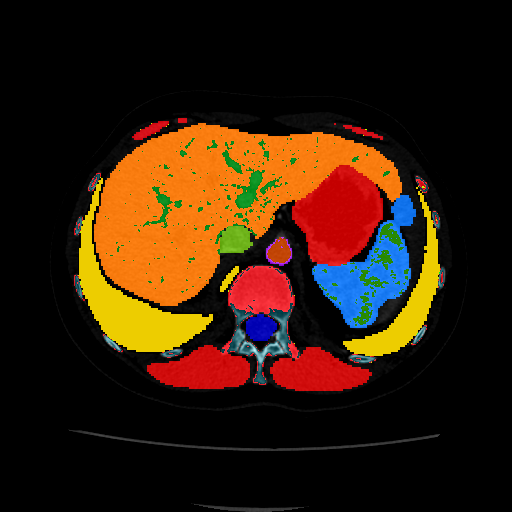 Segmentation noise · Issue #230 · wasserth/TotalSegmentator · GitHub