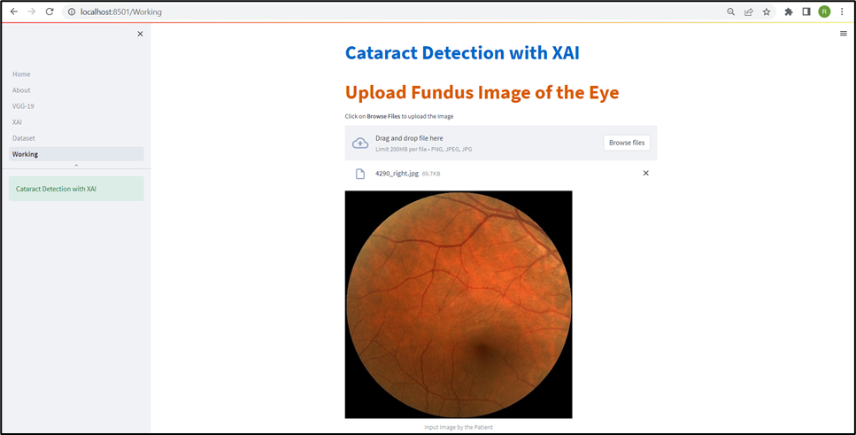 Github Rutwikpatel13cataractdetectionwithxai