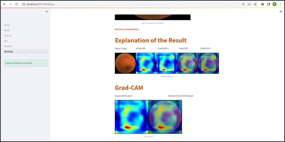 Github Rutwikpatel13 Cataract Detection With Xai