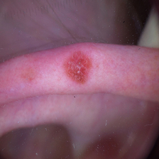 GitHub - Joydip-Basu-Biswas/Skin-cancer-detection: Predicting the Skin cancer with the Deep ...