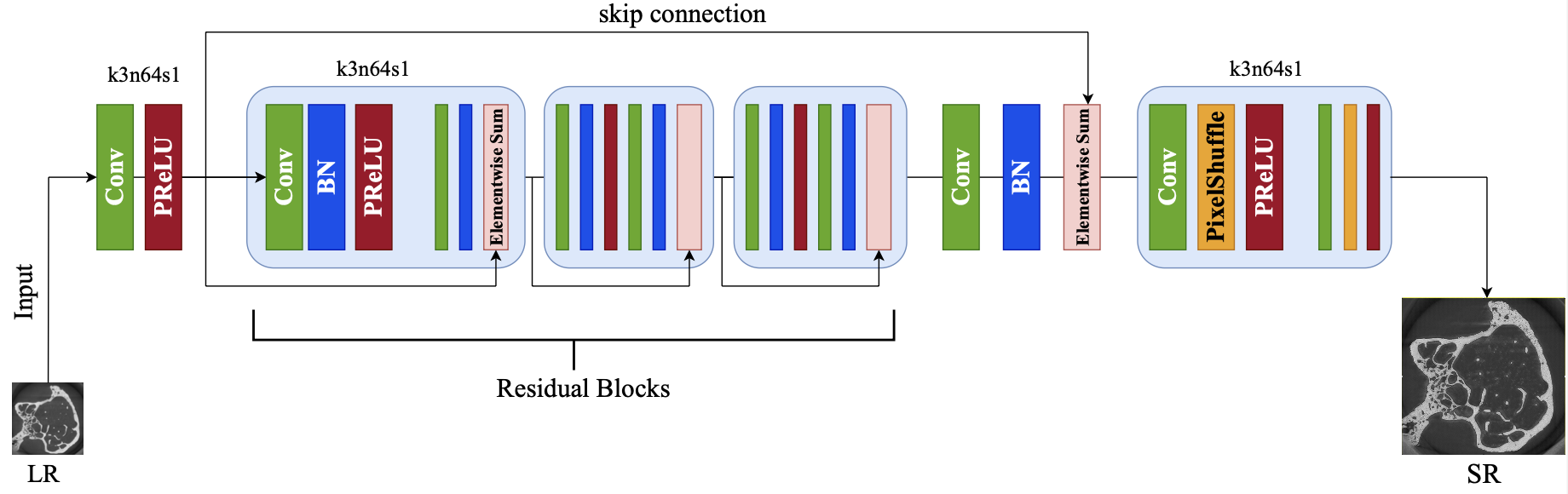 GitHub - adarshraghunath/Unsupervised-Super-Resolution-using-Cycle-GAN: Osteoporosis Detection