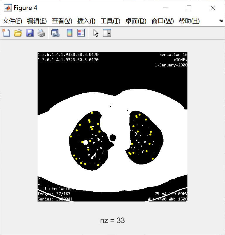GitHub - CEllmemichael/CT-images-of-the-lungs-matlab: 输入图像获得肺部内部的图像，并在 ...