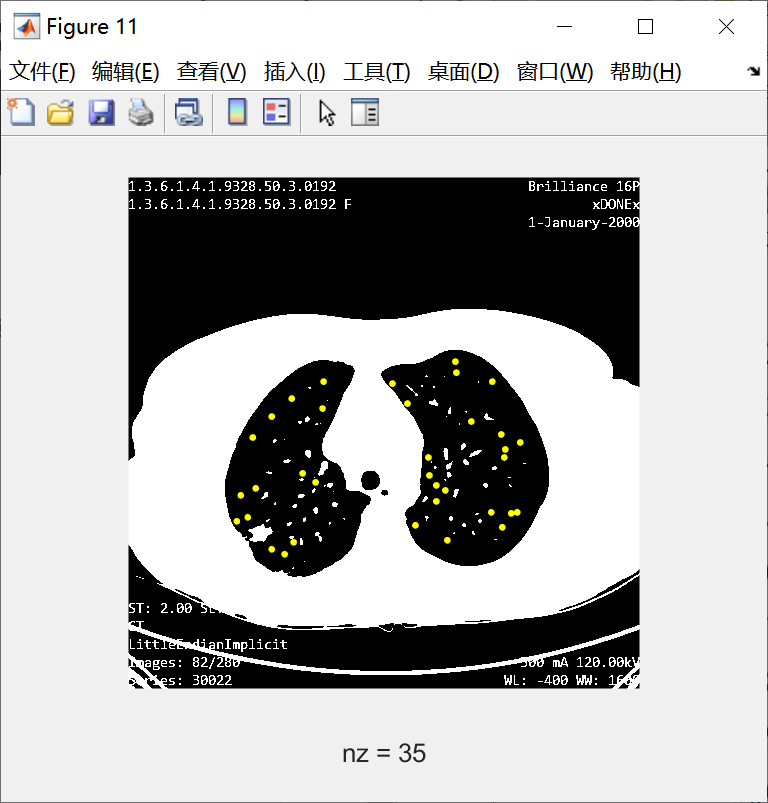 GitHub - CEllmemichael/CT-images-of-the-lungs-matlab: 输入图像获得肺部内部的图像，并在内部生成随机种子点