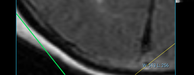 Interactive slice intersections · Issue #5544 · Slicer/Slicer · GitHub