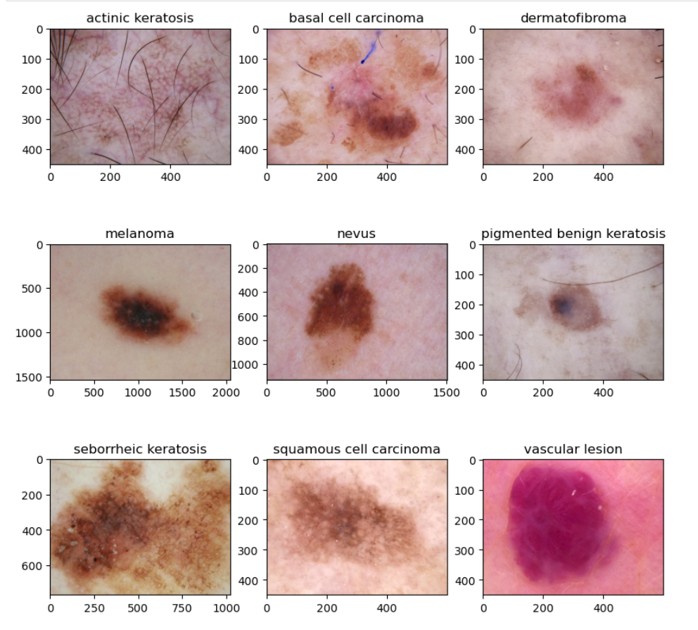 GitHub - prasadjoshi124/Melanoma-Skin-Cancer-Detection
