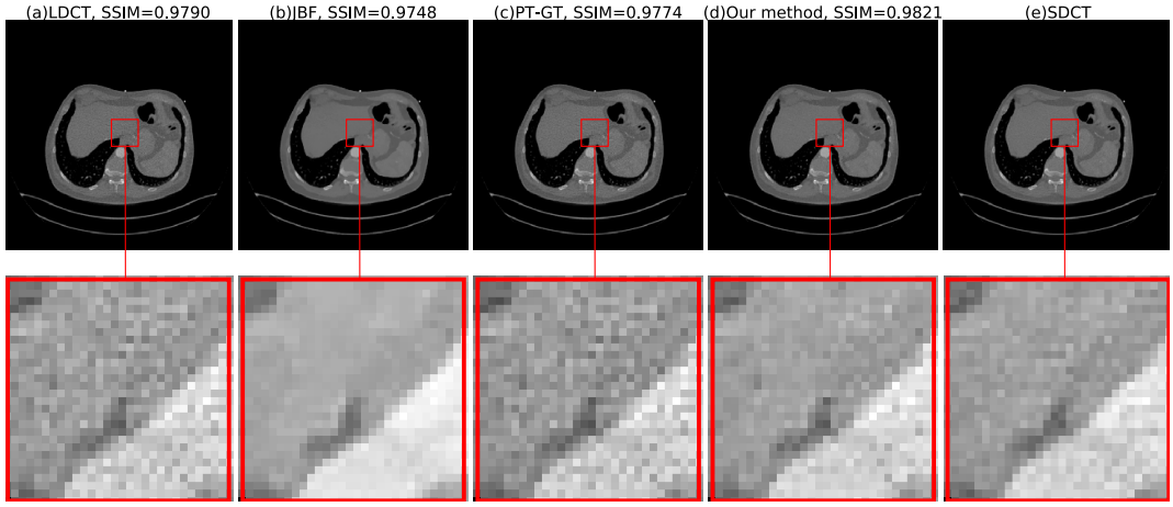 Low Dose CT Denoising via Joint Bilateral Filtering and Intelligent Parameter Optimization ...