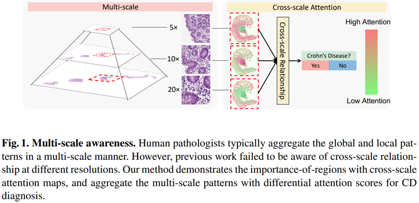 Cross-scale Attention Guided Multi-instance Learning for Crohn’s Disease Diagnosis with ...
