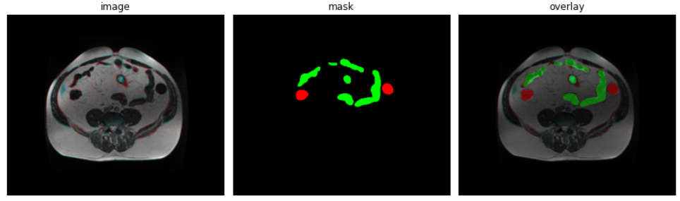 GitHub - inDSweTrust/UWMGI-Image-Segmentation