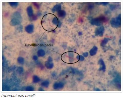 GitHub - aryamanwastaken/tensorvoting-tuberculosis: Applying tensor voting, a pattern ...