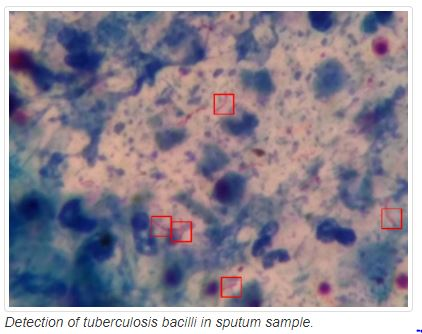 GitHub - aryamanwastaken/tensorvoting-tuberculosis: Applying tensor ...