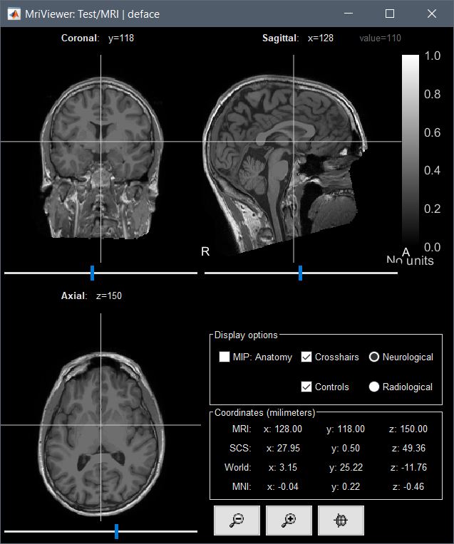 new method for defacing MRI (3D and 4D volume) · Issue #307 ...