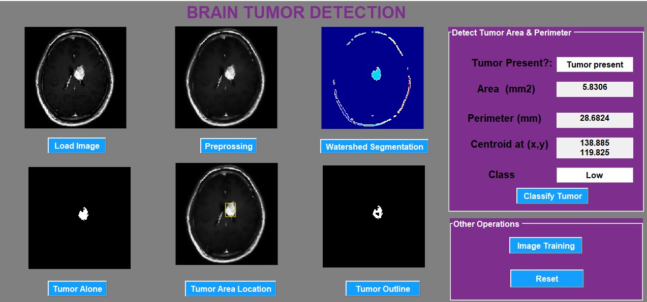 GitHub - Shindujah2107/Brain-Tumor-Detection--MATLAB-Project: Develop a ...