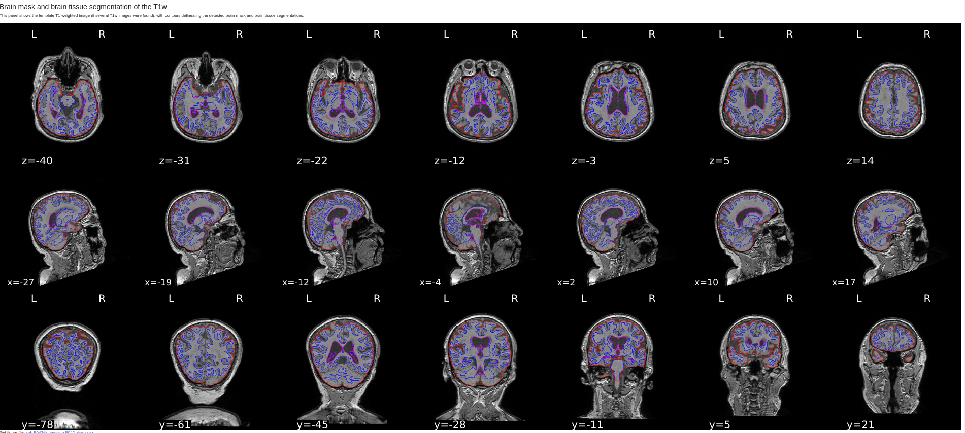 Failed Normalization of BOLD · Issue #2410 · nipreps/fmriprep · GitHub